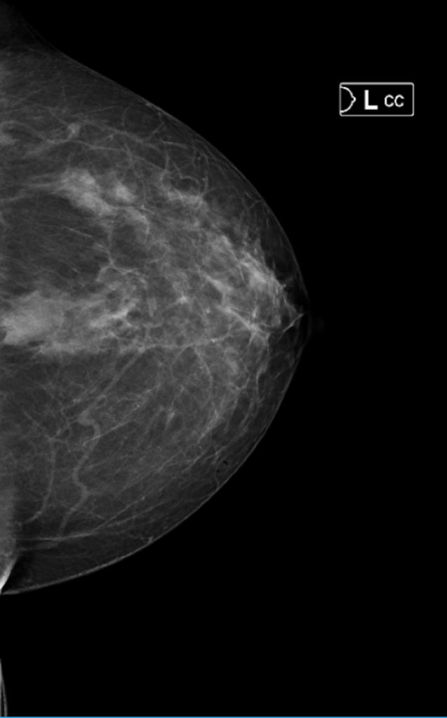 Mammography Segmentation Dataset | 3,000 Studies - unidata.pro