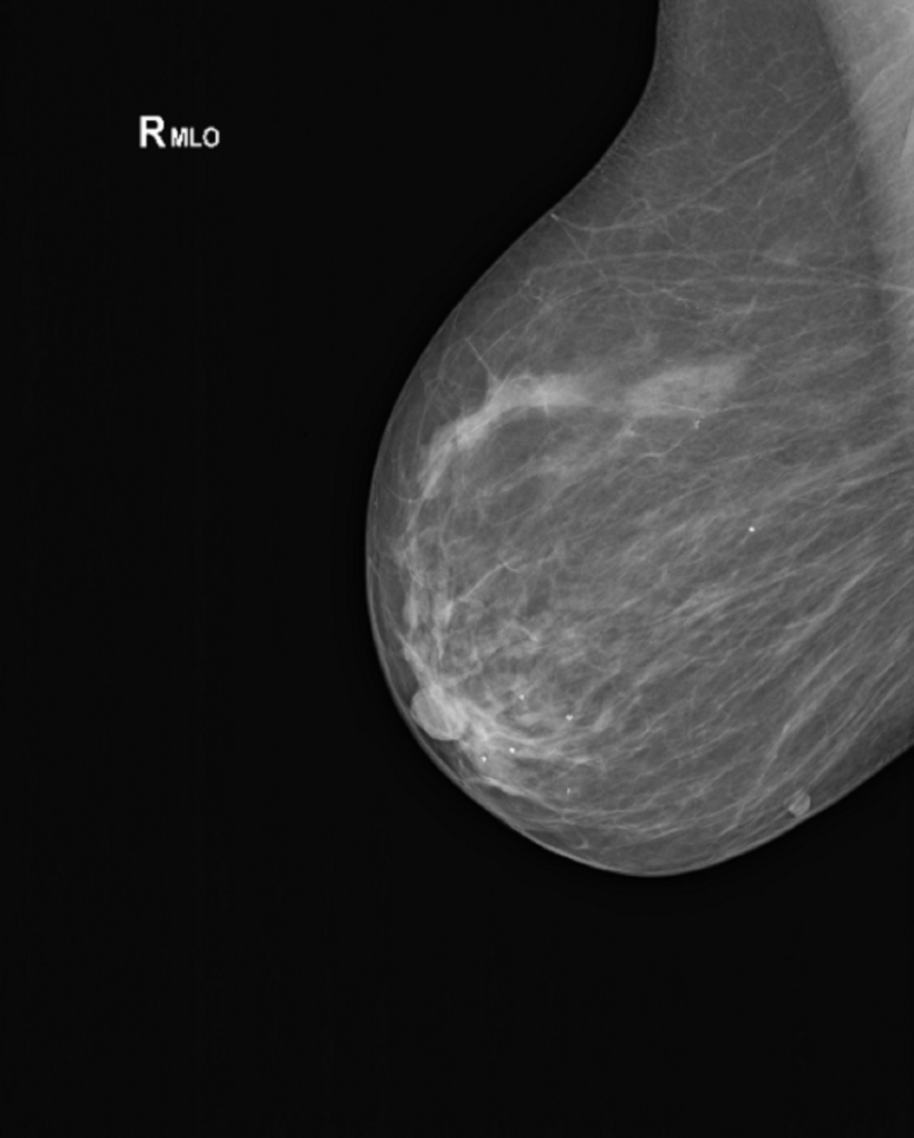 Mammography Segmentation Dataset Unidata Pro