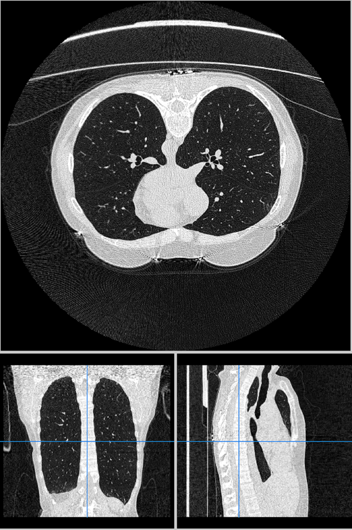 Chest CT Segmentation Dataset | 1000 Studies - unidata.pro